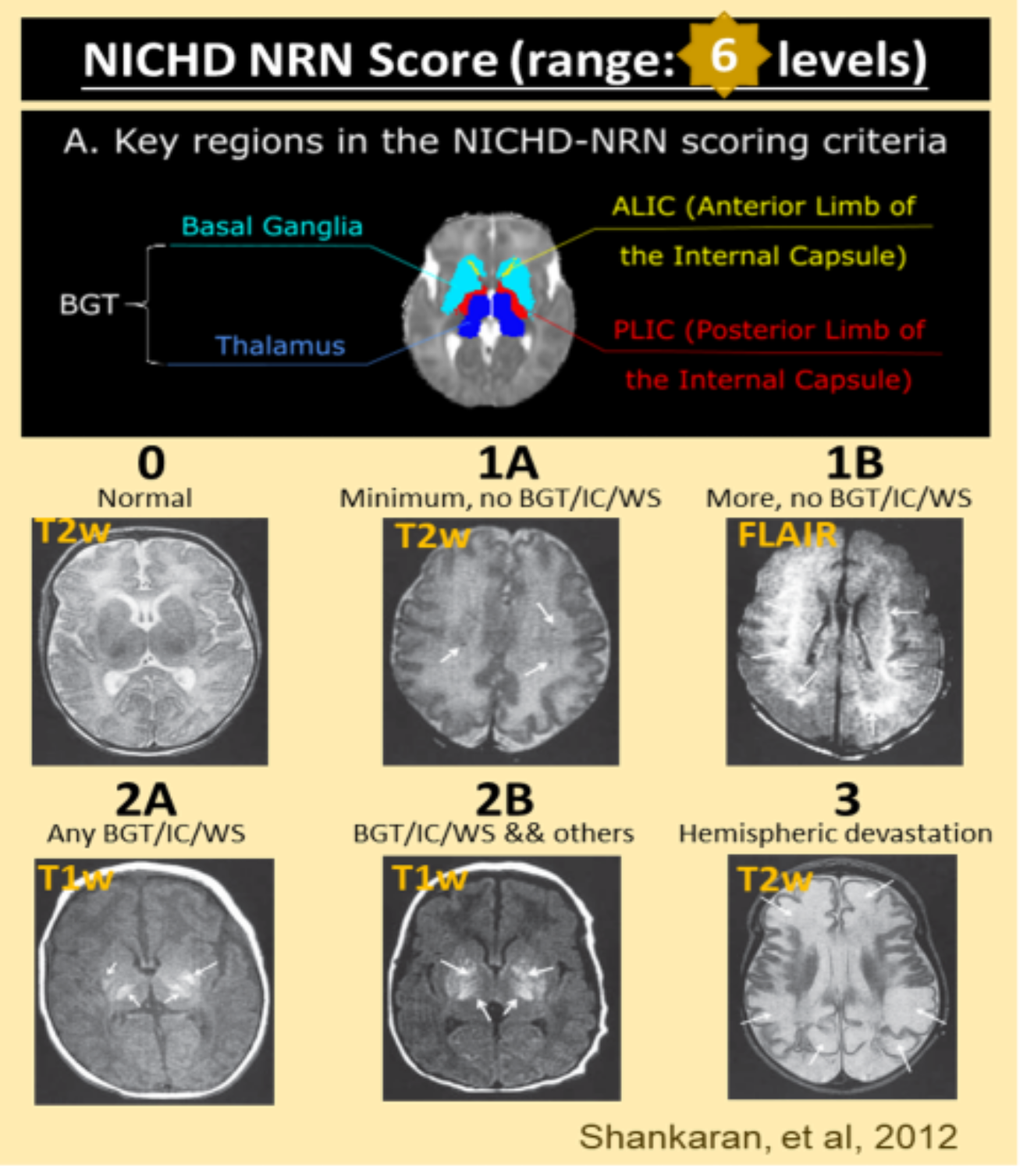 Neonatal Brain Injury | Image, Informatics & Intelligence (i3) Research Lab